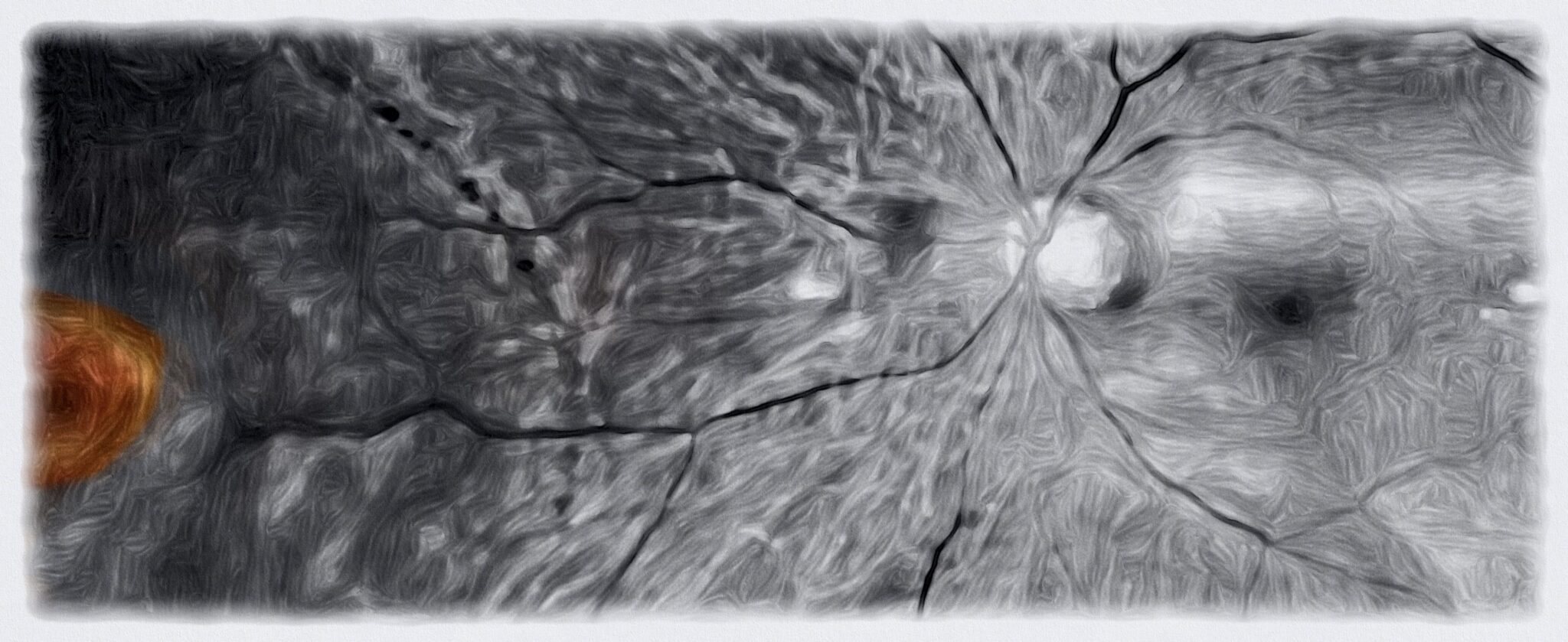 Déchirure de la rétine - Centre d'Ophtalmologie du Dauphine à Grenoble (38)