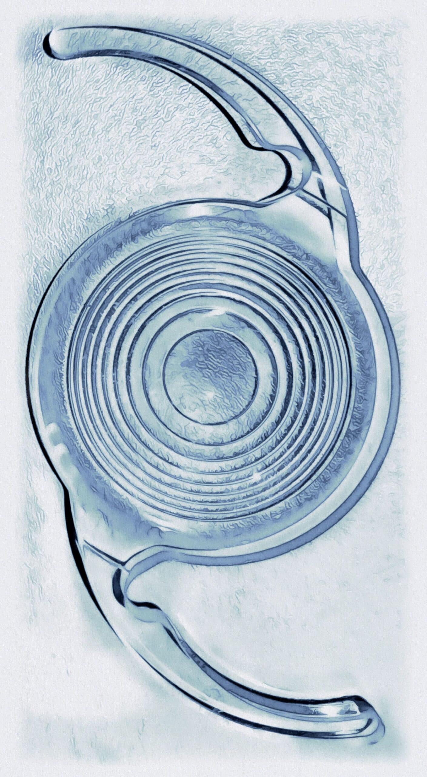 Implant cristallinien multifocal - Centre d'Ophtalmologie du Dauphine à ...