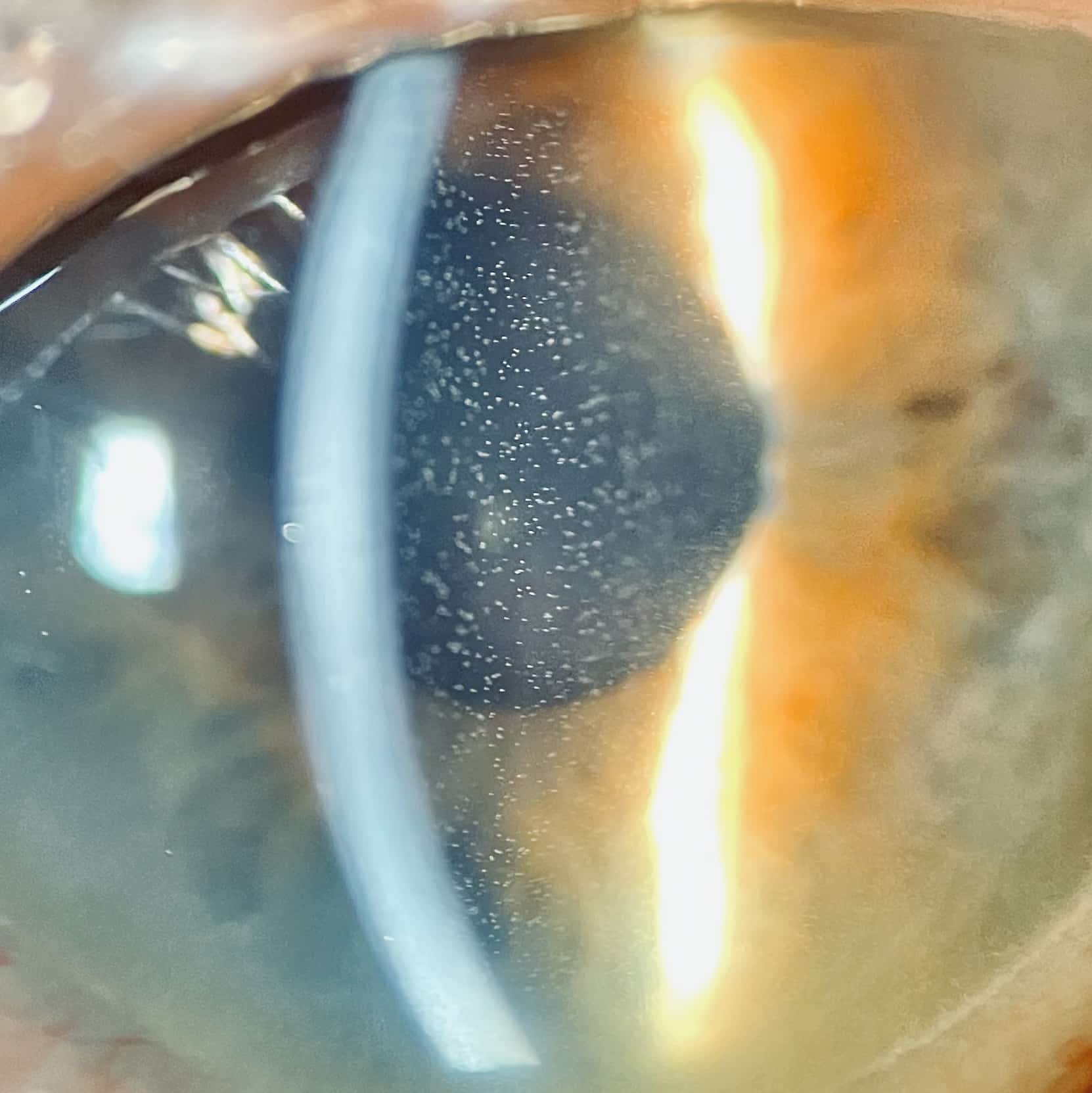 Uvéite - Centre d'Ophtalmologie du Dauphine à Grenoble (38)